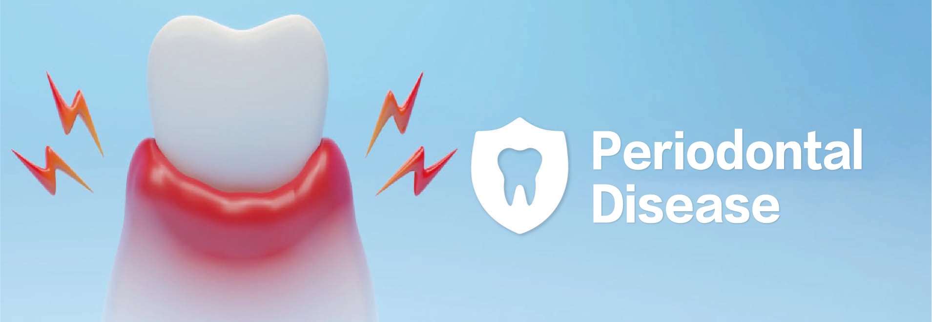 Periodontal Disease - DENSBEAUTY